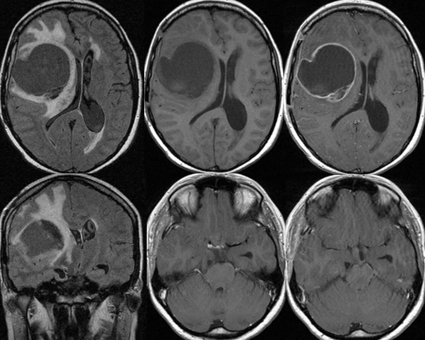 Recurrent GBM With Uncal Herniation Recurrent GBM With Uncal Herniation