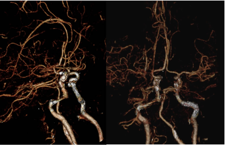 R A2 thrombosis with ACA infarction