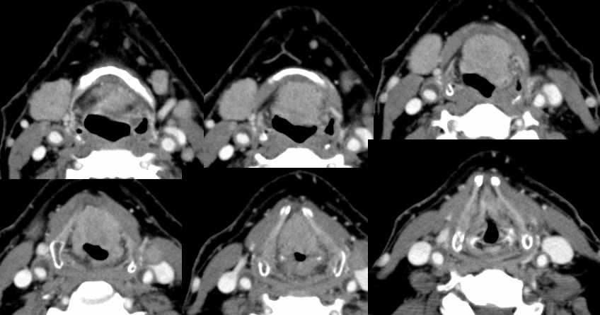 Squamous Cell Carcinoma