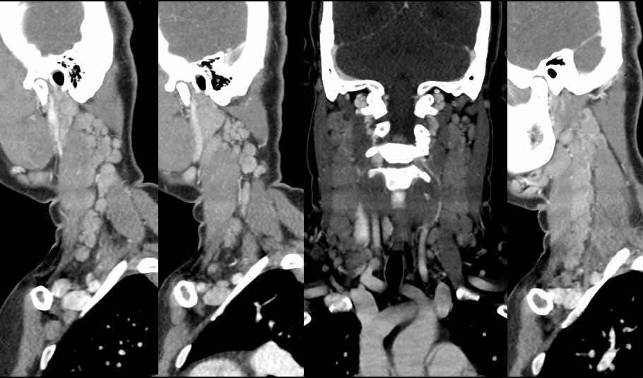 SLE reactive adenopathy
