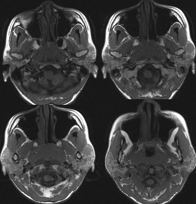 lymphoid hyperplasia HIV