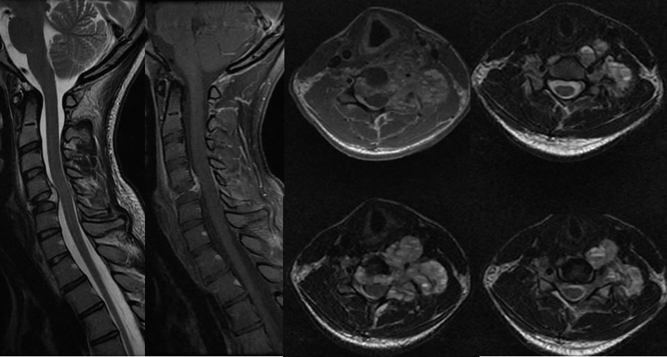 Aneurysmal Bone Cyst