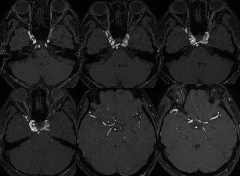 Direct Carotid Cavernous Fistula