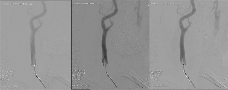 Direct Carotid Cavernous Fistula