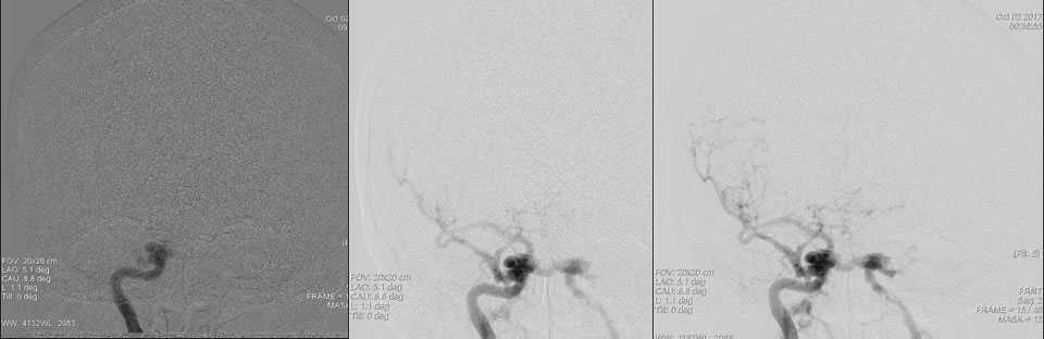 Direct Carotid Cavernous Fistula