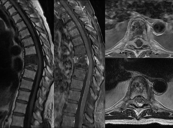 Epidural and Leptomeningeal Metastases, Lung Cancer