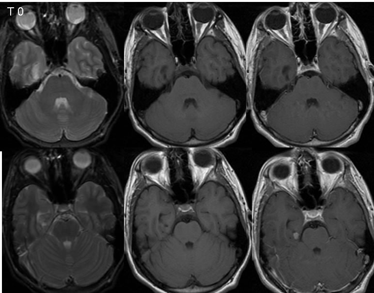 Ganglioglioma