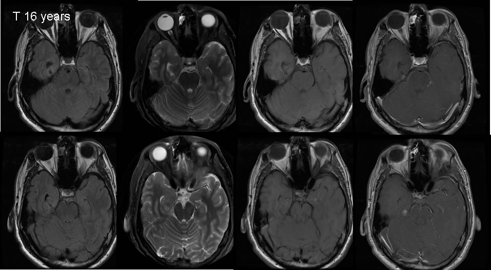 Ganglioglioma