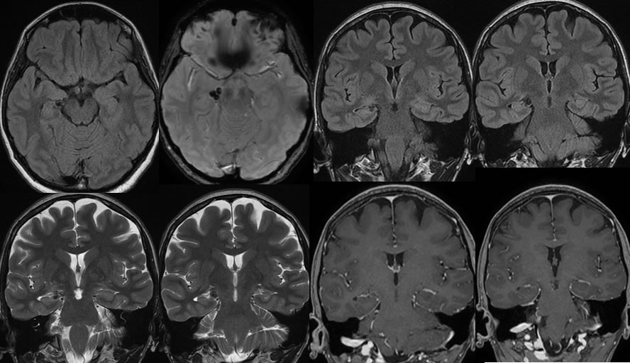 Ganglioglioma