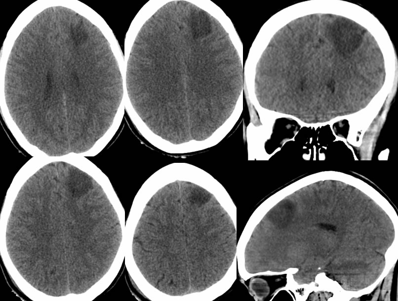 Grade 2 Astrocytoma