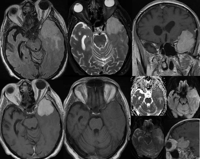Grade 2 atypical meningioma