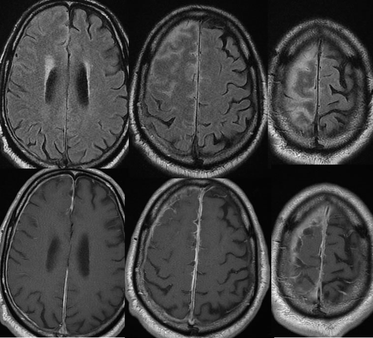 meningitis