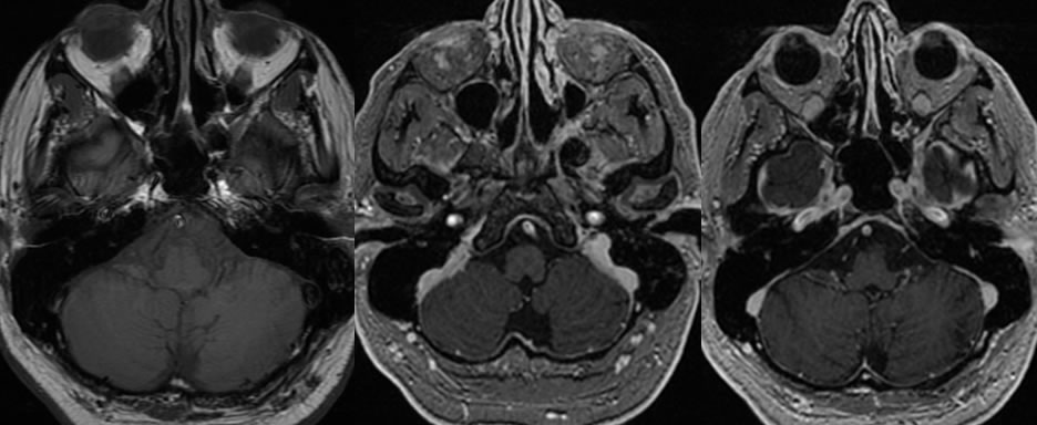 SNUC with perineural tumor spread
